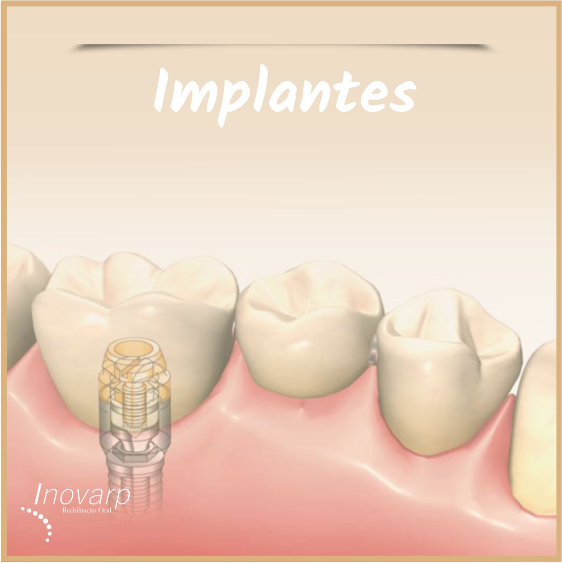 Implantes – Inovarp – Dra. Claudia Bustamante
