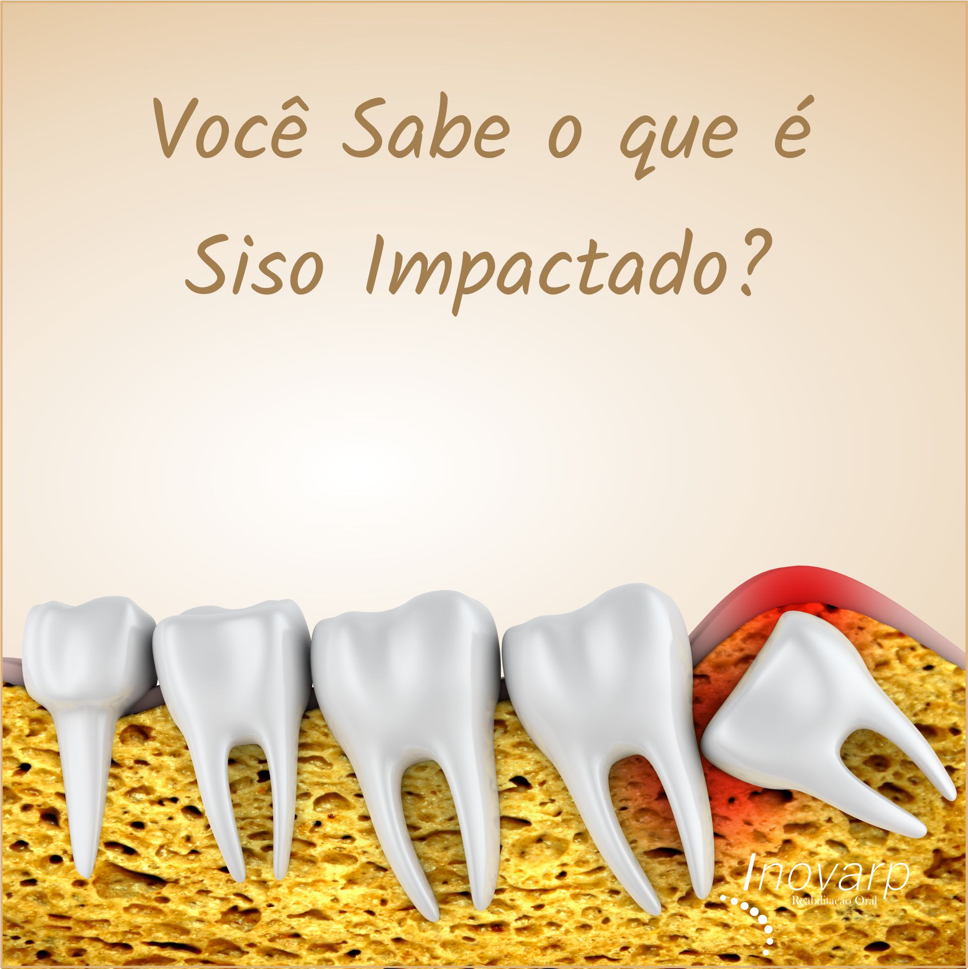 Siso Impactado – Inovarp – Dra. Claudia Bustamante