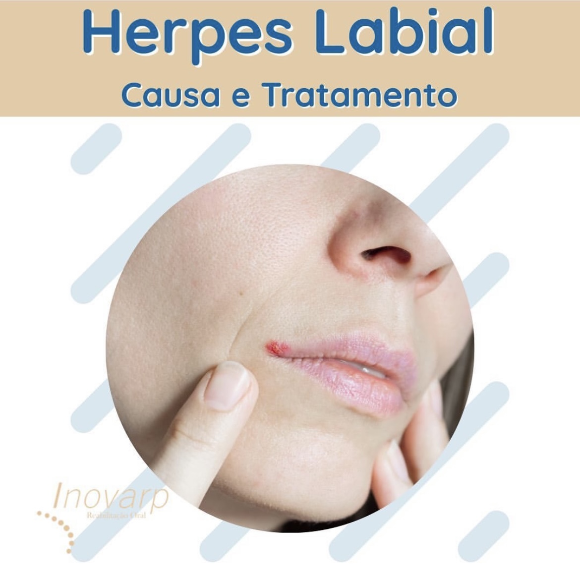 Herpes Labial – Inovarp – Dra. Claudia Bustamante